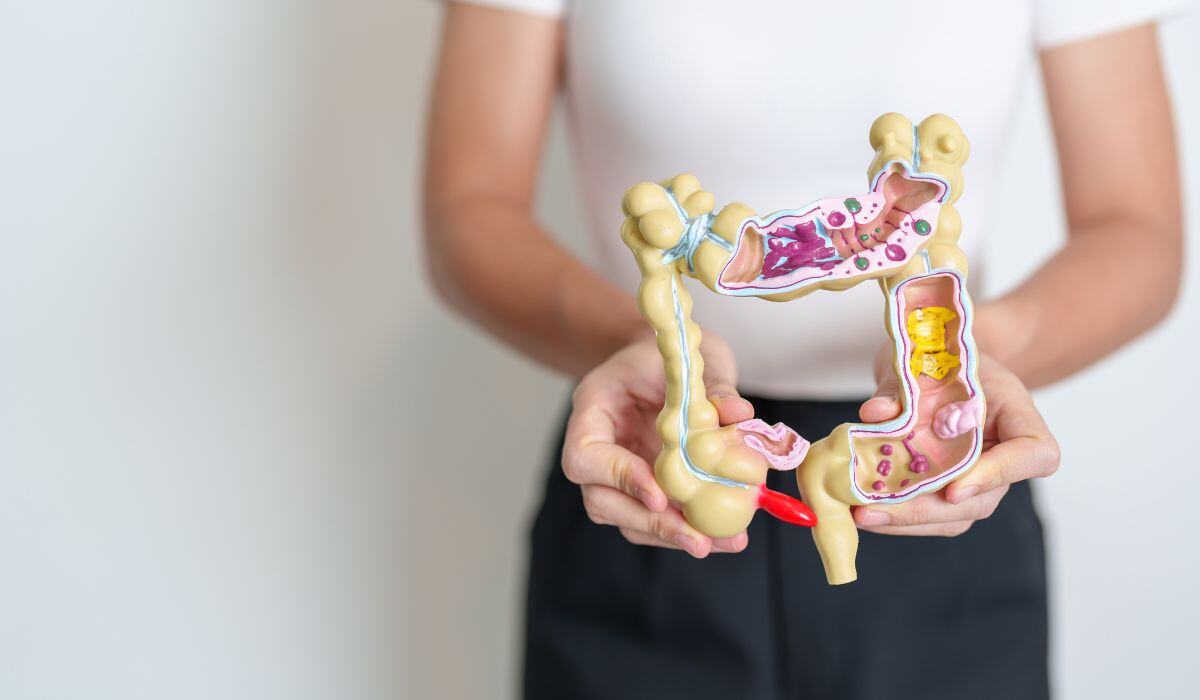 Colon Polyps: Are They Cancer? Colon Polyps: Are They Cancer?
